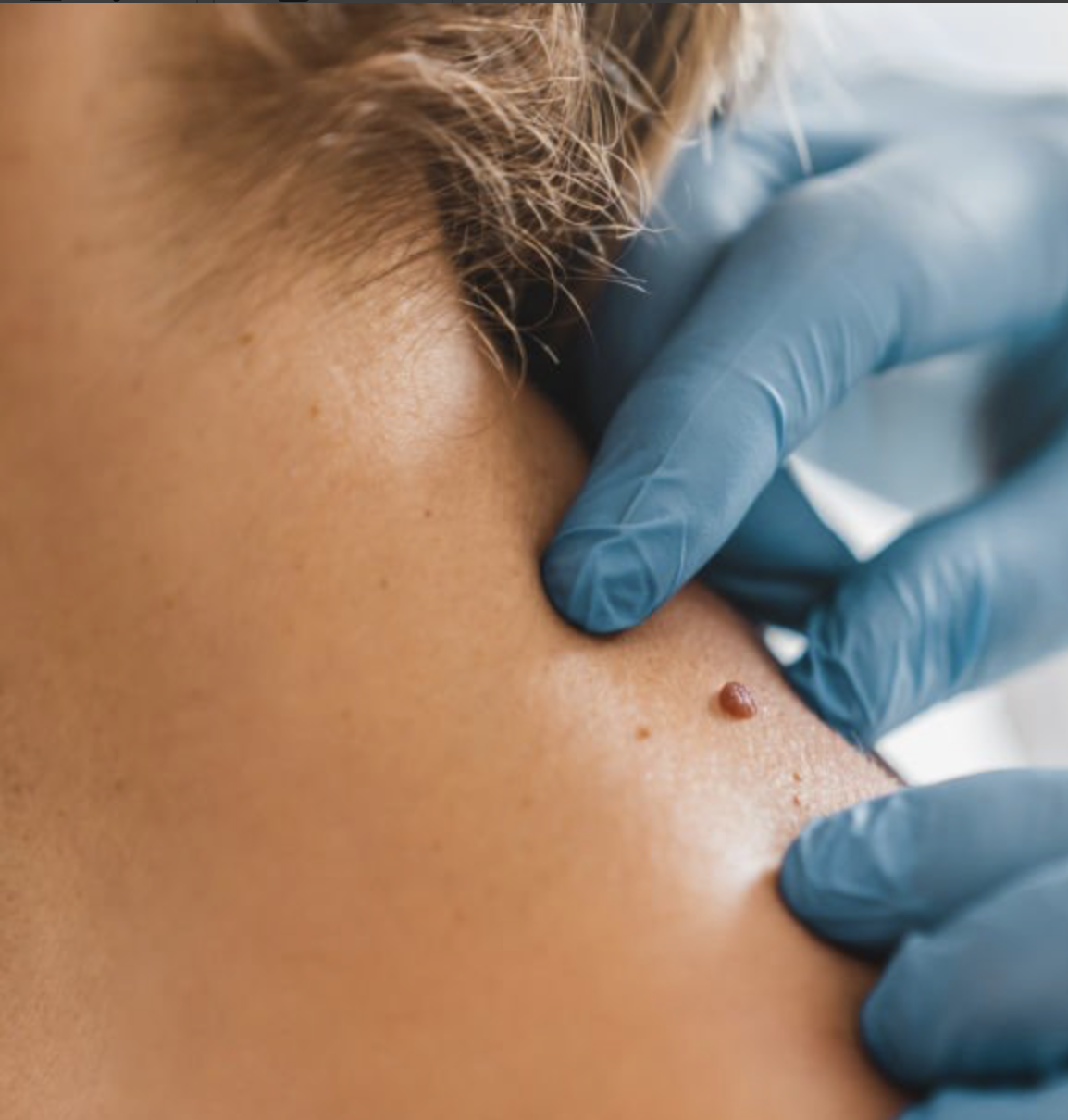 Skin Tags vs Cysts vs Warts - MD Aesthetics
